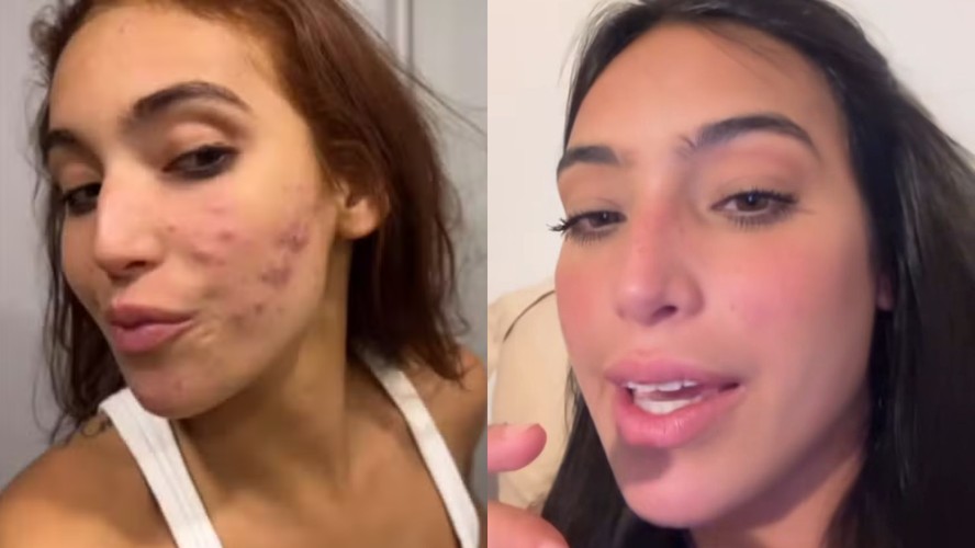 Após chorar por acne, Vanessa Lopes comemora melhora no rosto: 'Muito ...