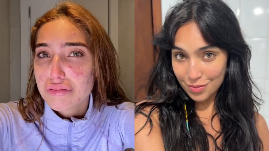 Vanessa Lopes mostra antes e depois de acne severa: 'Lembrete que tudo ...