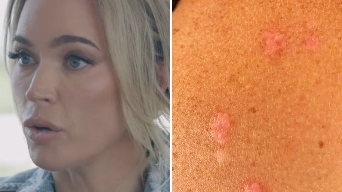 Estrela de reality show desabafa após remoção do 16º melanoma: 'Sempre ...