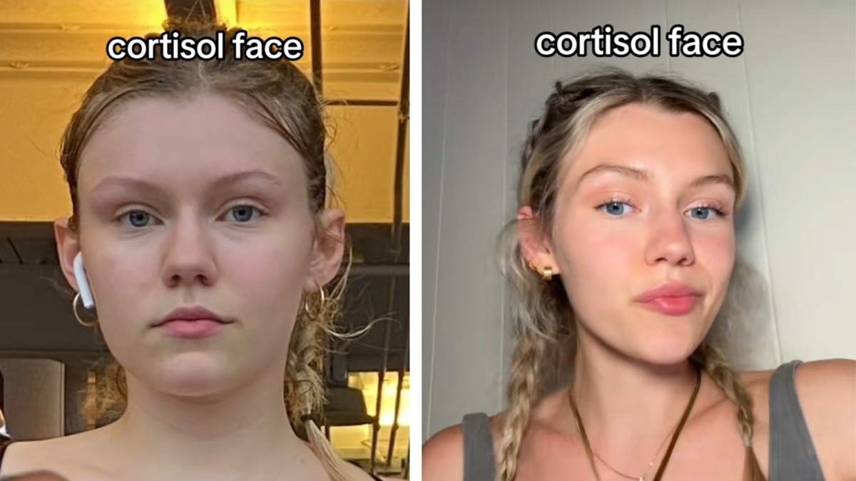‘Cortisol face’: pode esse hormônio ser o culpado de um rosto redondo?