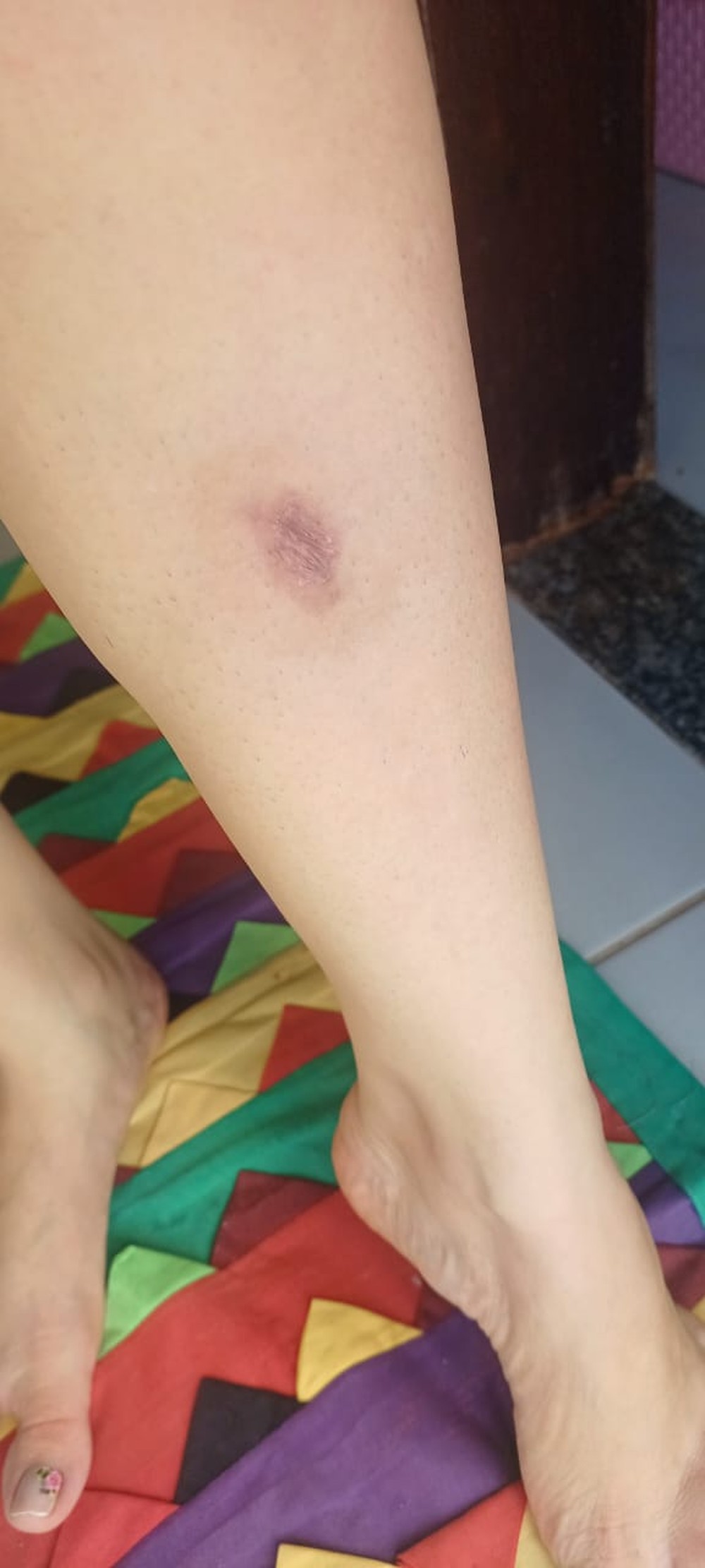‘Quase parei de andar depois de tirar um pelo encravado na perna com ...
