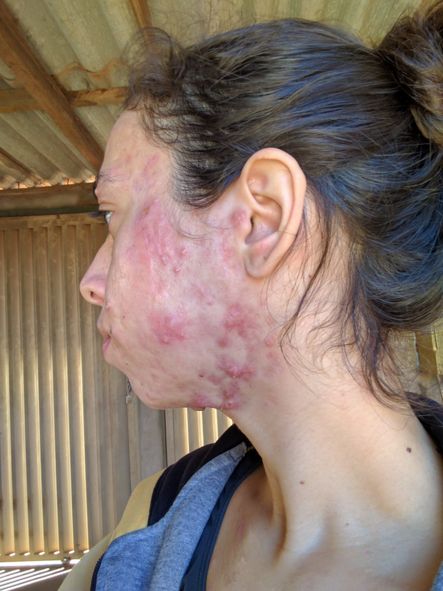 Influenciadora viraliza ao mostrar realidade da acne severa: 'Doía na ...