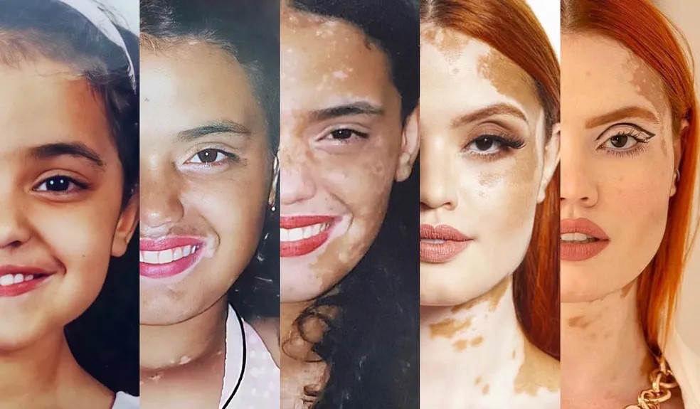 'Tratamento é diferente hoje que sou socialmente lida como branca', diz influenciadora com vitiligo