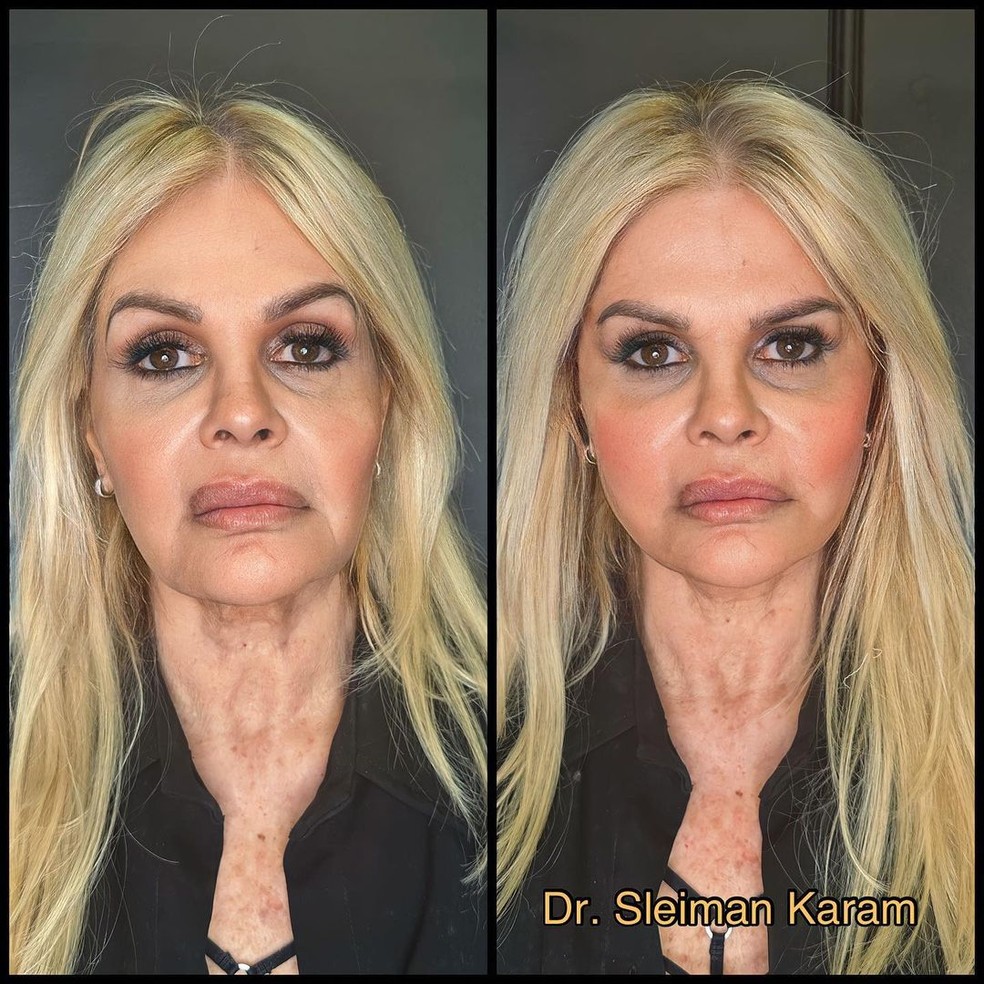 Monique Evans posta nova foto após harmonização facial e semelhança com ...