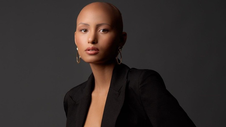 Modelo com alopecia usa a internet para desmistificar a doença: ‘Acham ...