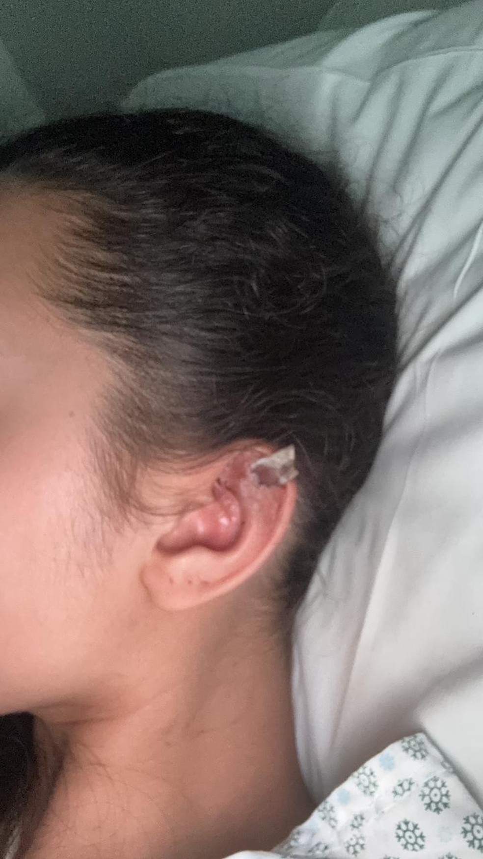 Piercing infeccionado: “A bactéria comeu um pedaço da cartilagem da ...