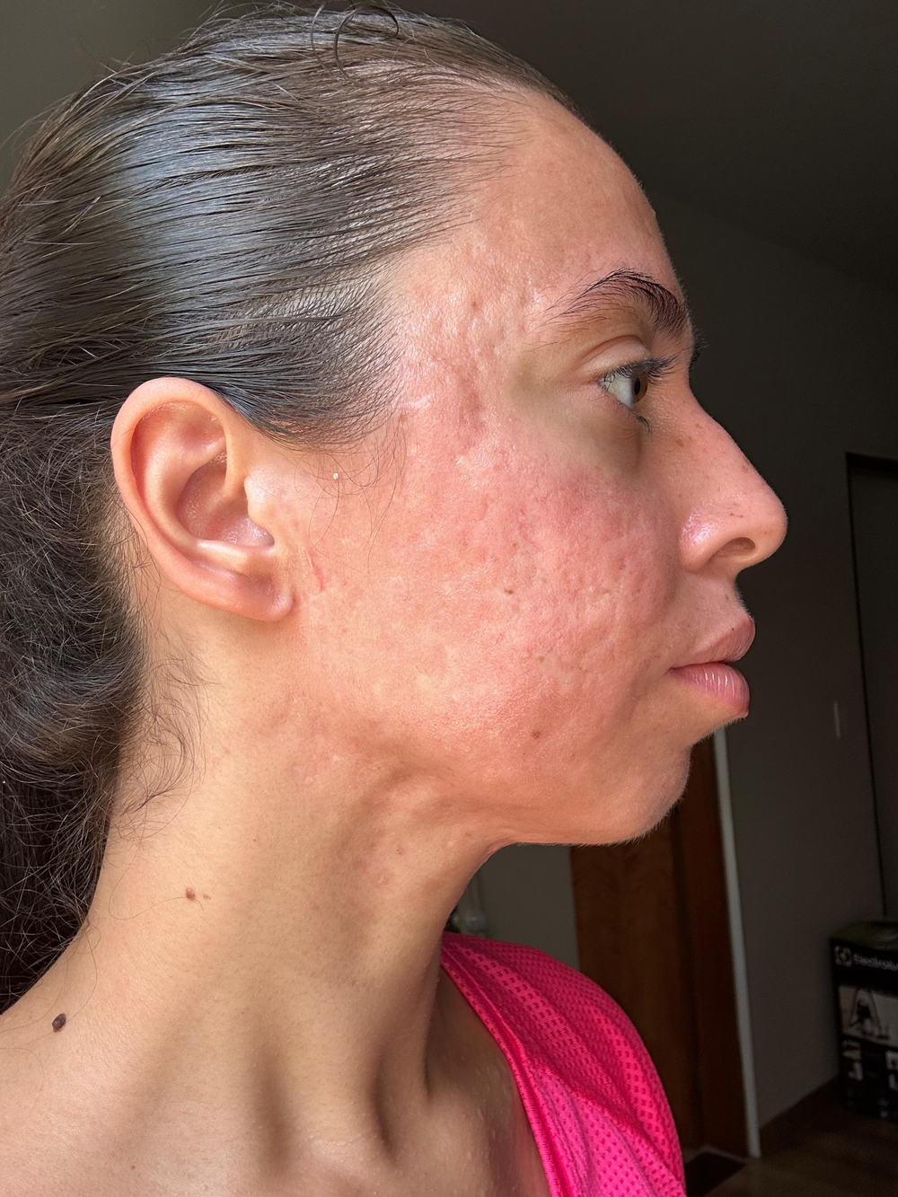 Influenciadora viraliza ao mostrar realidade da acne severa: 'Doía na ...