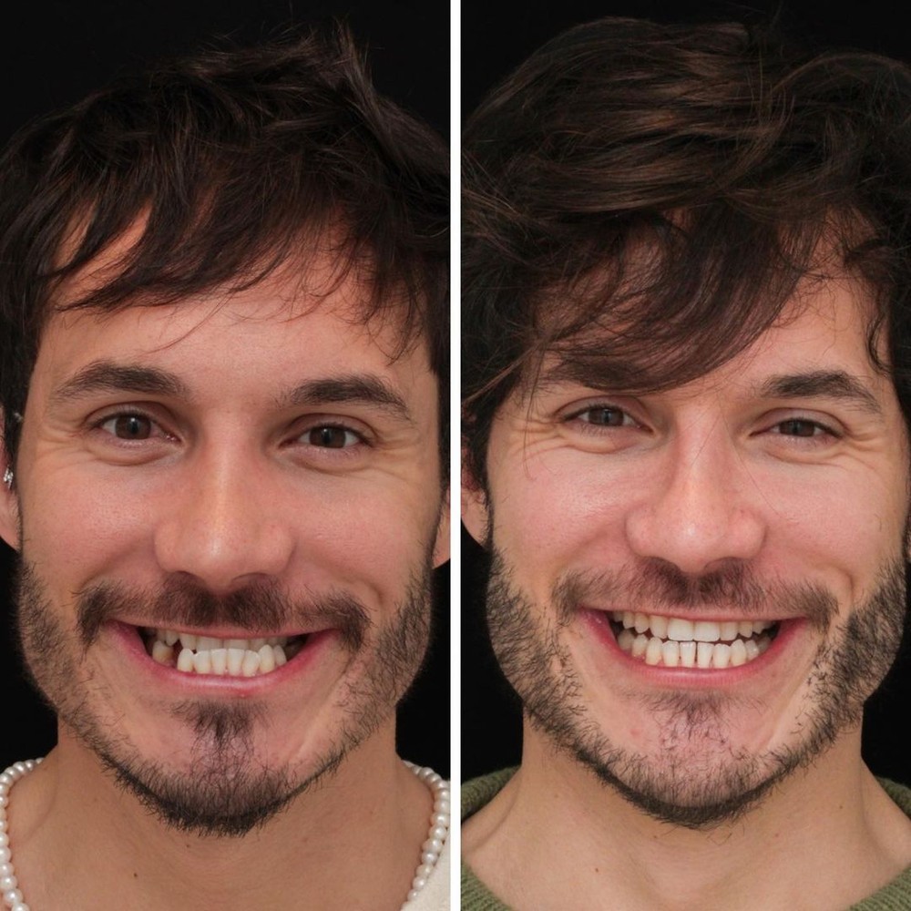 Eliezer mostra antes e depois de procedimento nos dentes e Viih Tube ...