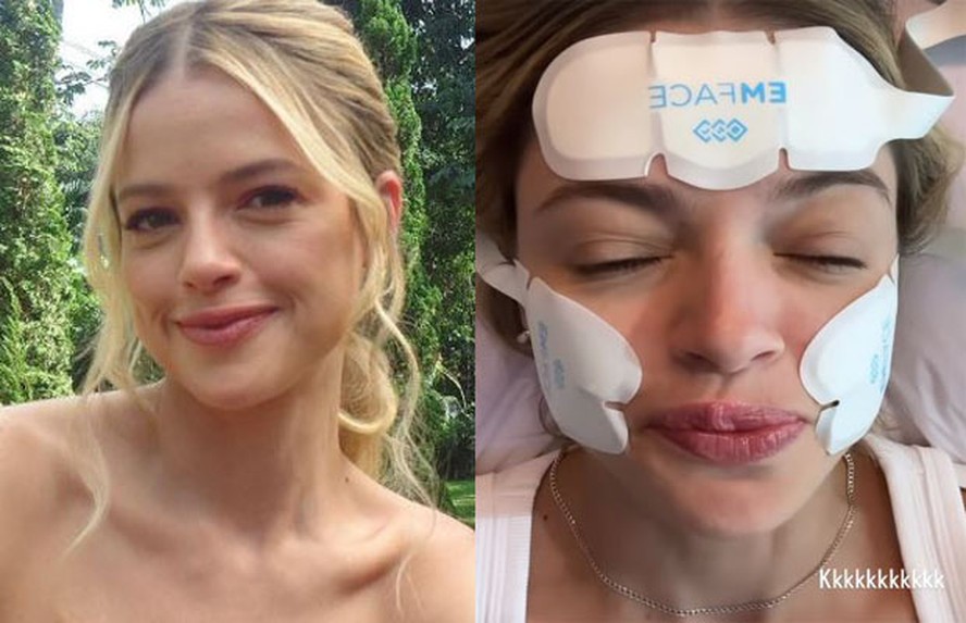 Agatha Moreira fica com rosto paralisado ao mostrar tratamento estético