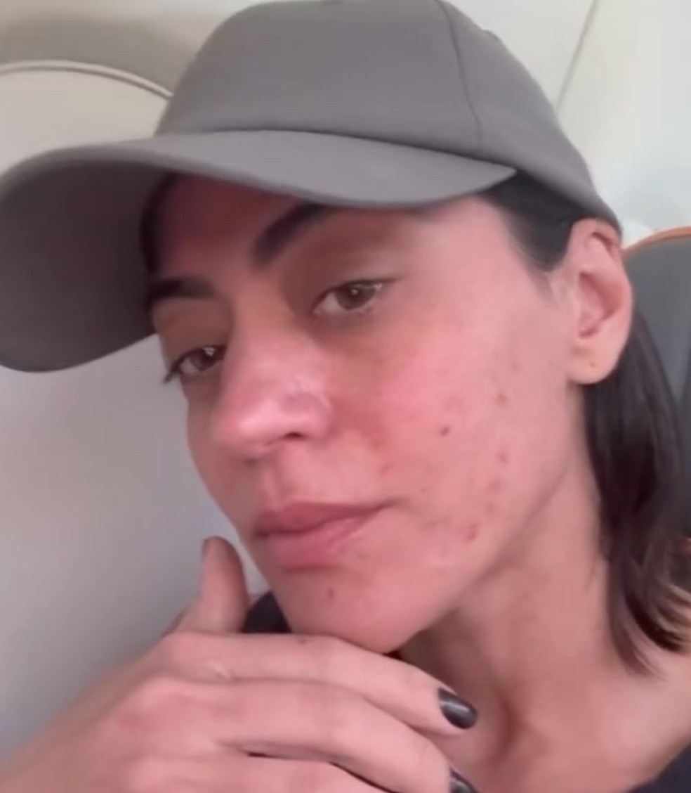 Carol Castro exibe rosto sem maquiagem e explica inflamações: 'Eu fico ...