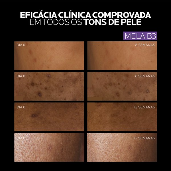 Eficaz contra as manchas, inclusive as causadas pela acne