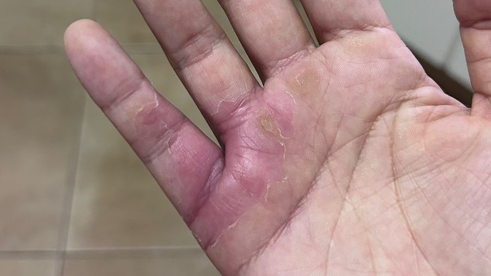 'Quase perdi o dedo da mão por causa do CrossFit, após uma bolha ...