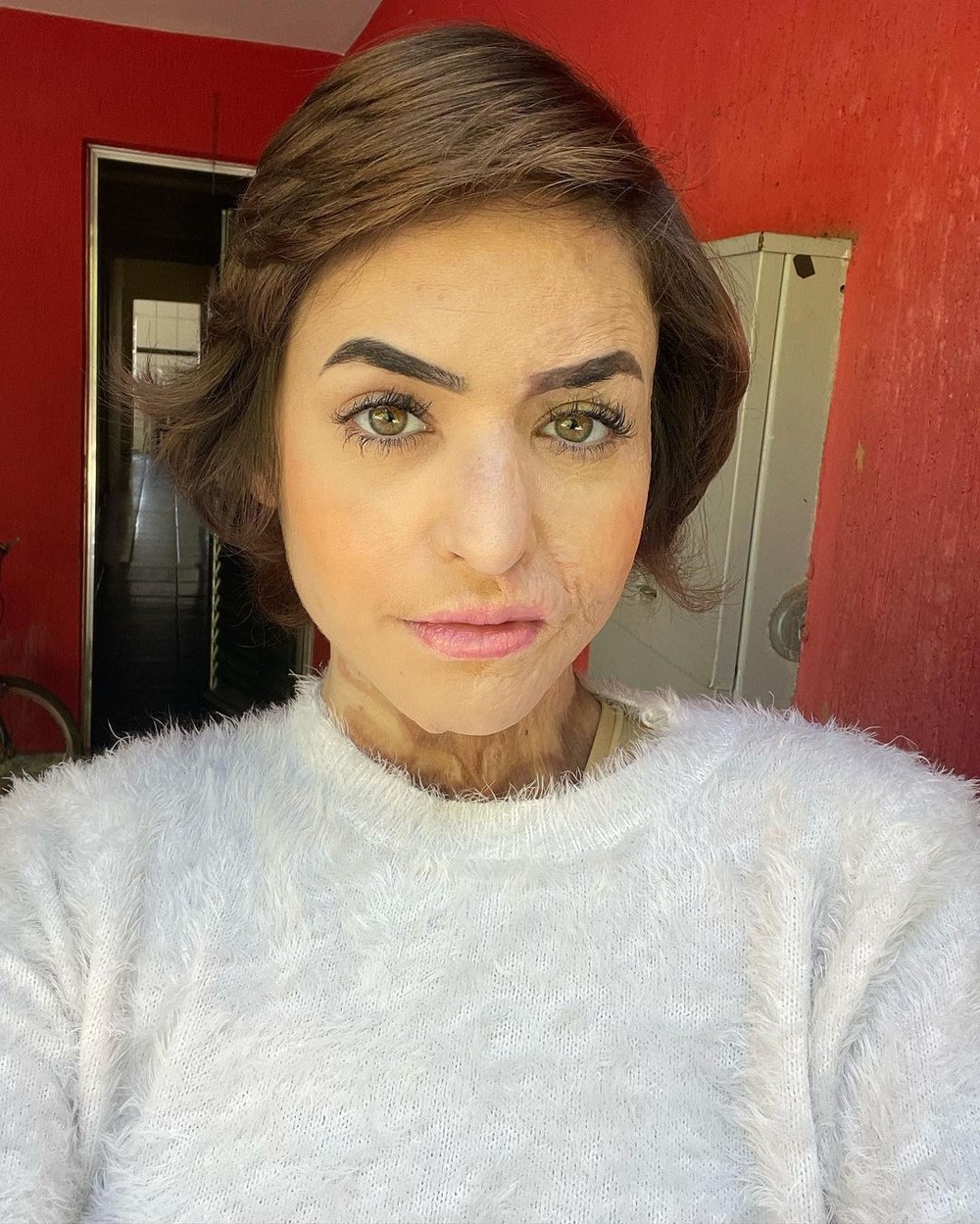 Sobrevivente de explosão, Maria Eduarda inspira mulheres a lidarem com ...