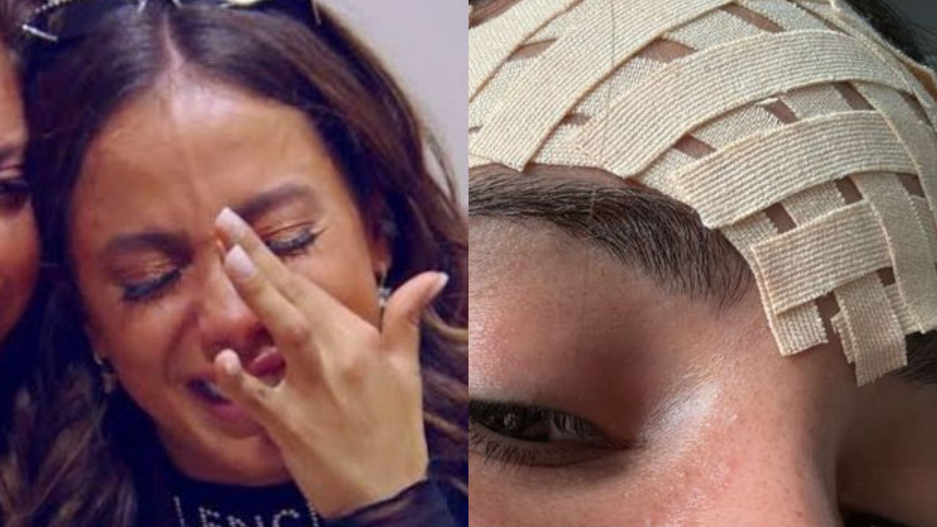 Anitta passa por cirurgia para remover veias saltadas na testa: 'Só ...
