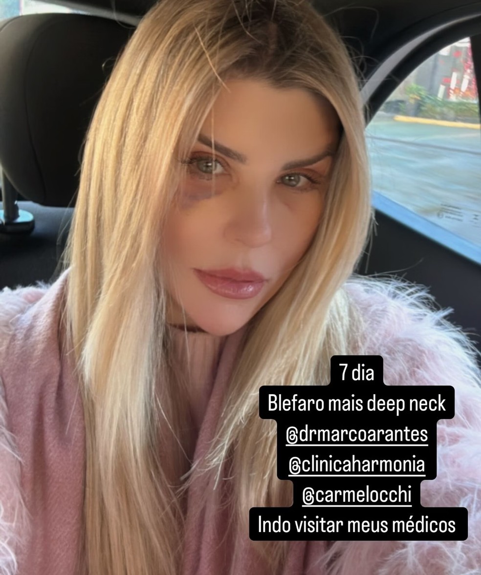 Ex-BBB Iris Stefanelli mostra rosto 28 dias após série de cirurgias: 'Um dos maiores ...
