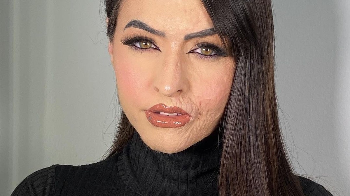 Sobrevivente de explosão, Maria Eduarda inspira mulheres a lidarem com ...