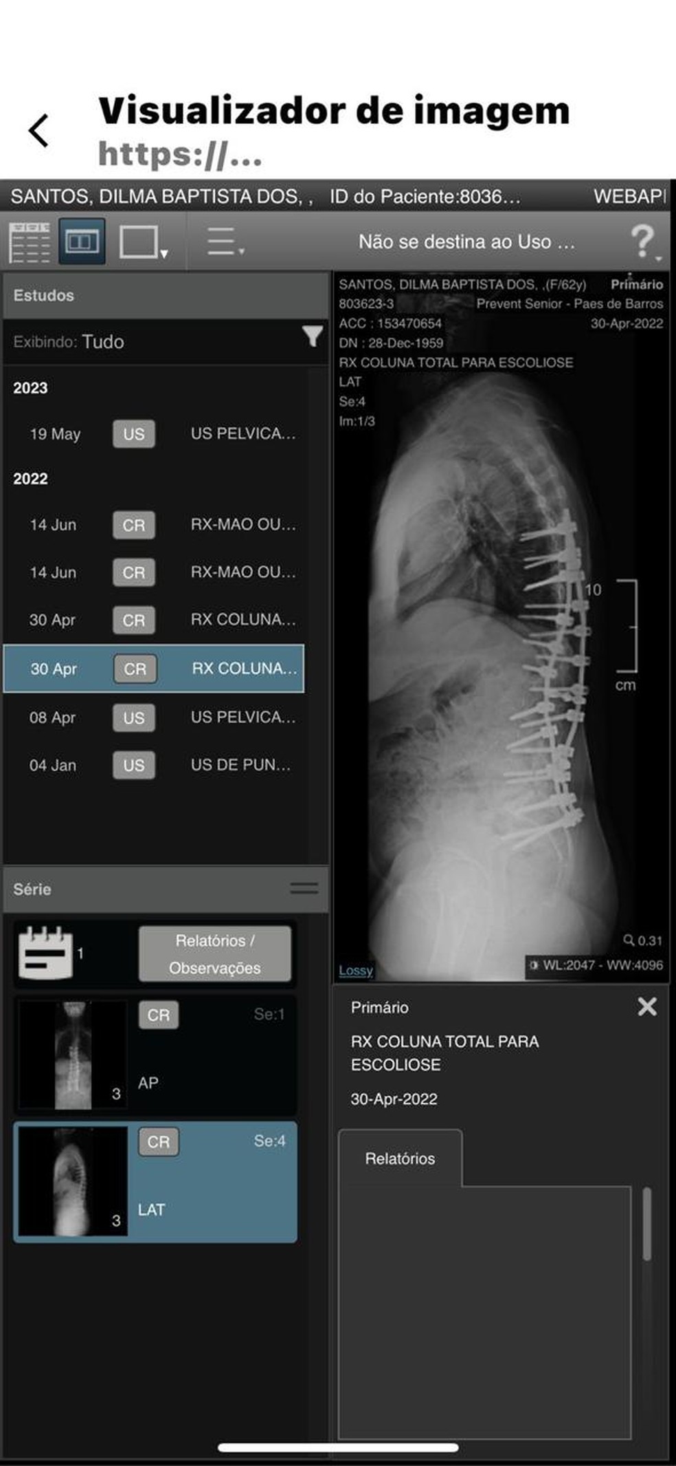 ‘Eu tomava morfina todo dia pra dor na coluna e saí da cirurgia sem ...