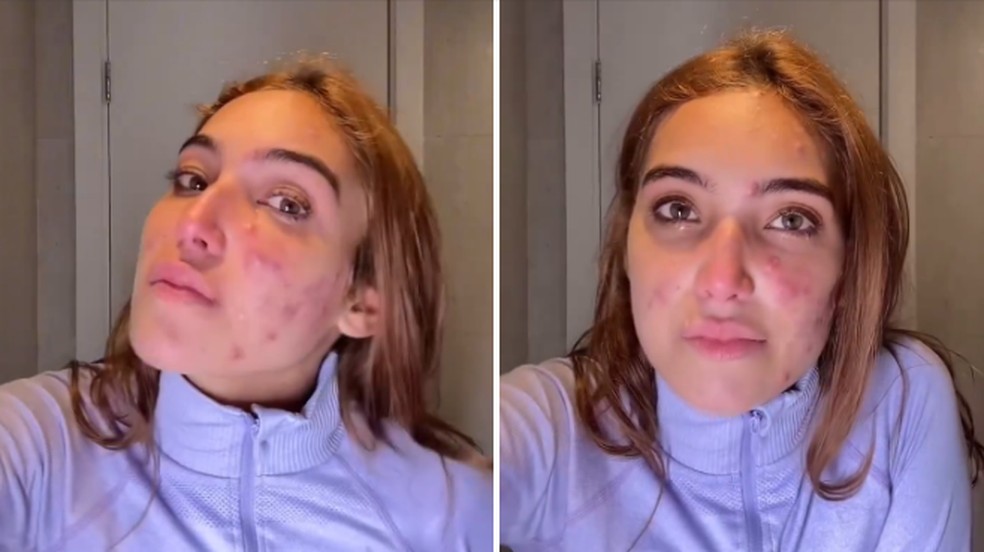 Após chorar por acne, Vanessa Lopes comemora melhora no rosto: 'Muito ...
