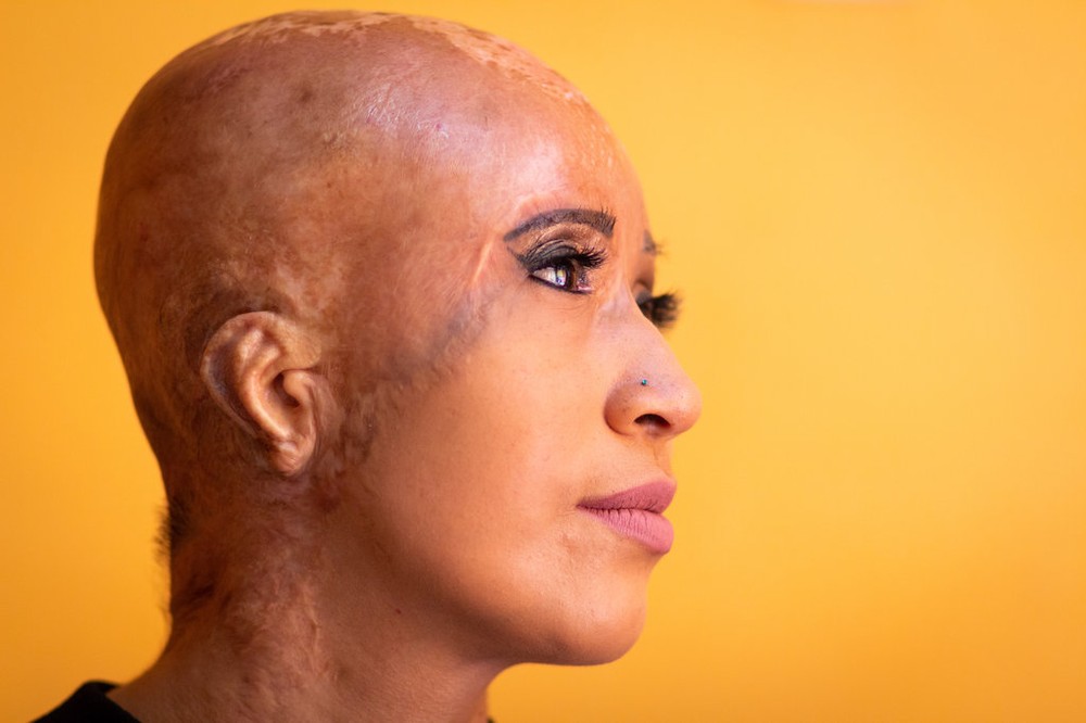 Escalpelamento e os impactos no couro cabeludo: 'Cheguei com uma parte ...