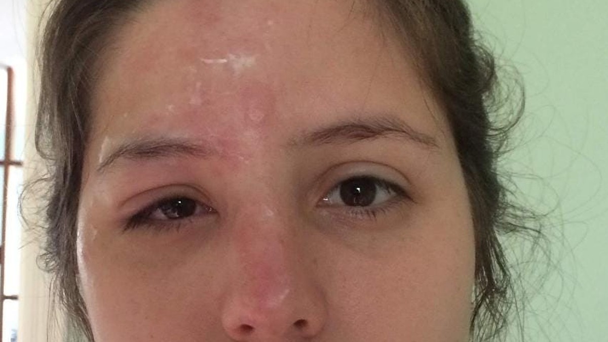 ‘Tive herpes-zóster aos 26 anos’: doença associada a idosos também ...